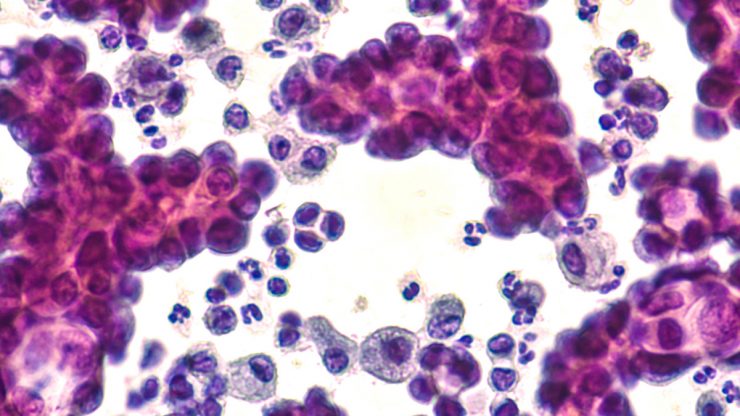 Can AI Aid in Predicting Cancer Survivability? | Adelphi University